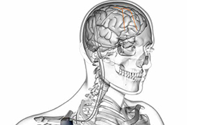 The Object: Conductive wire for deep brain stimulation